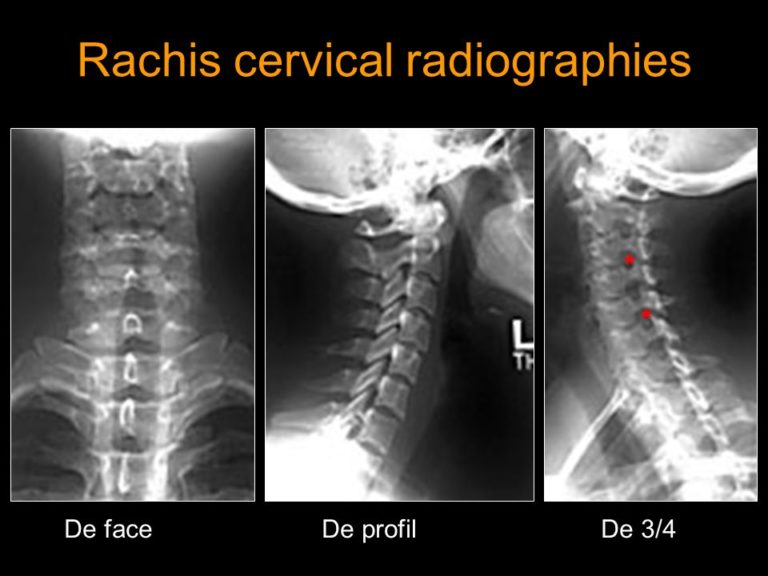 Rachis cervical radiographies .PDF - ETUDE-AZ